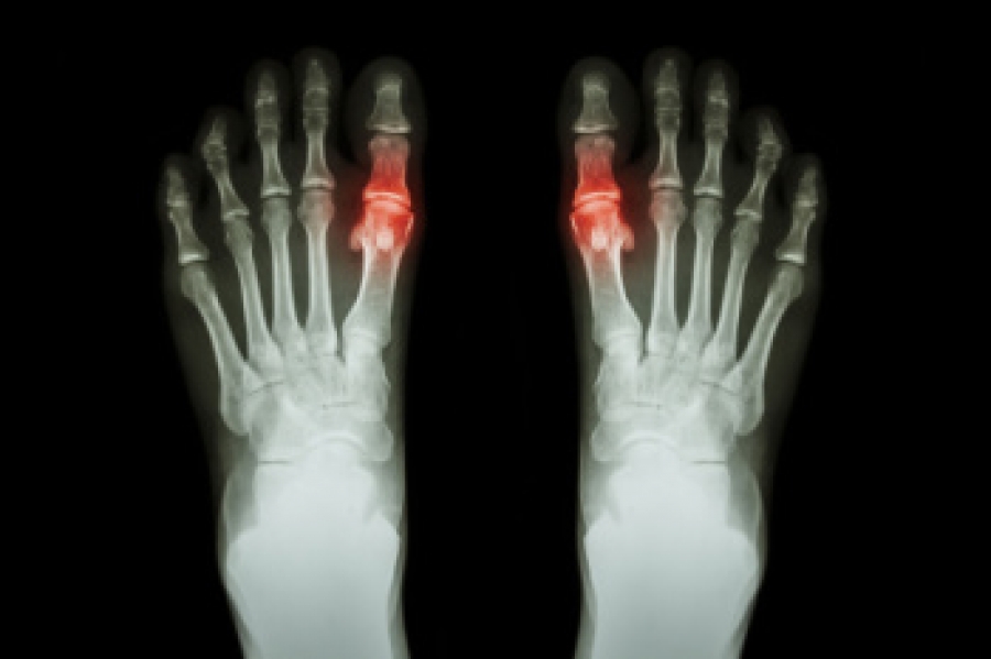 Recognizing Gout Symptoms And Warning Signs